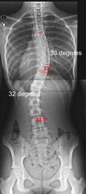 3 Things You Didn't Know About Scoliosis - Align Therapy Clinic, Utah