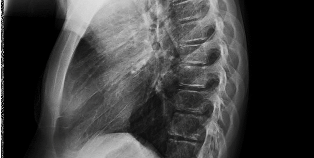 Patient Snapshot: Hyperkyphosis | Align Therapy